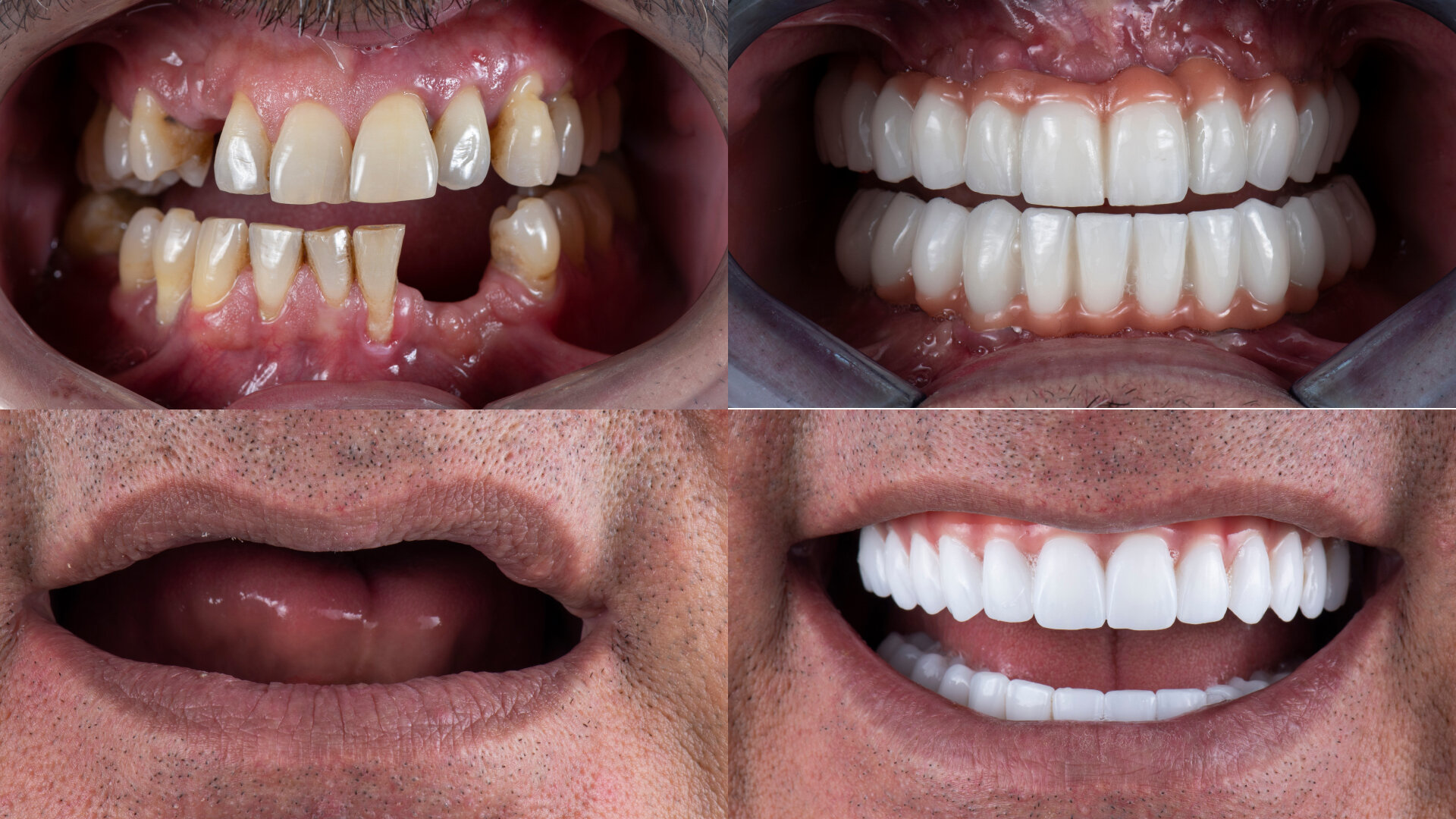 How much does it cost to get full dental implants in Turkey?