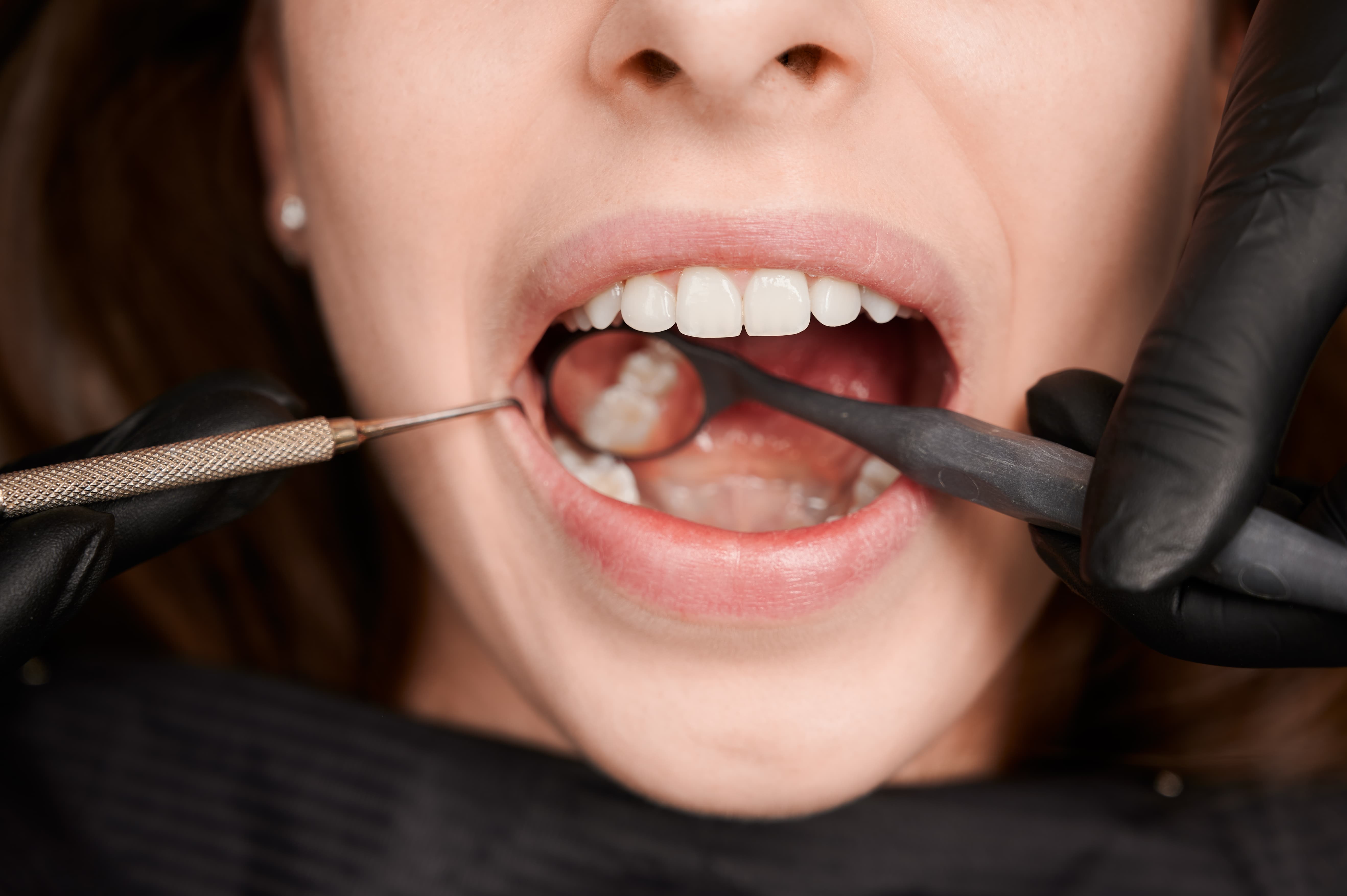 Root Canal Therapy Explained: A Pain-Free Guide