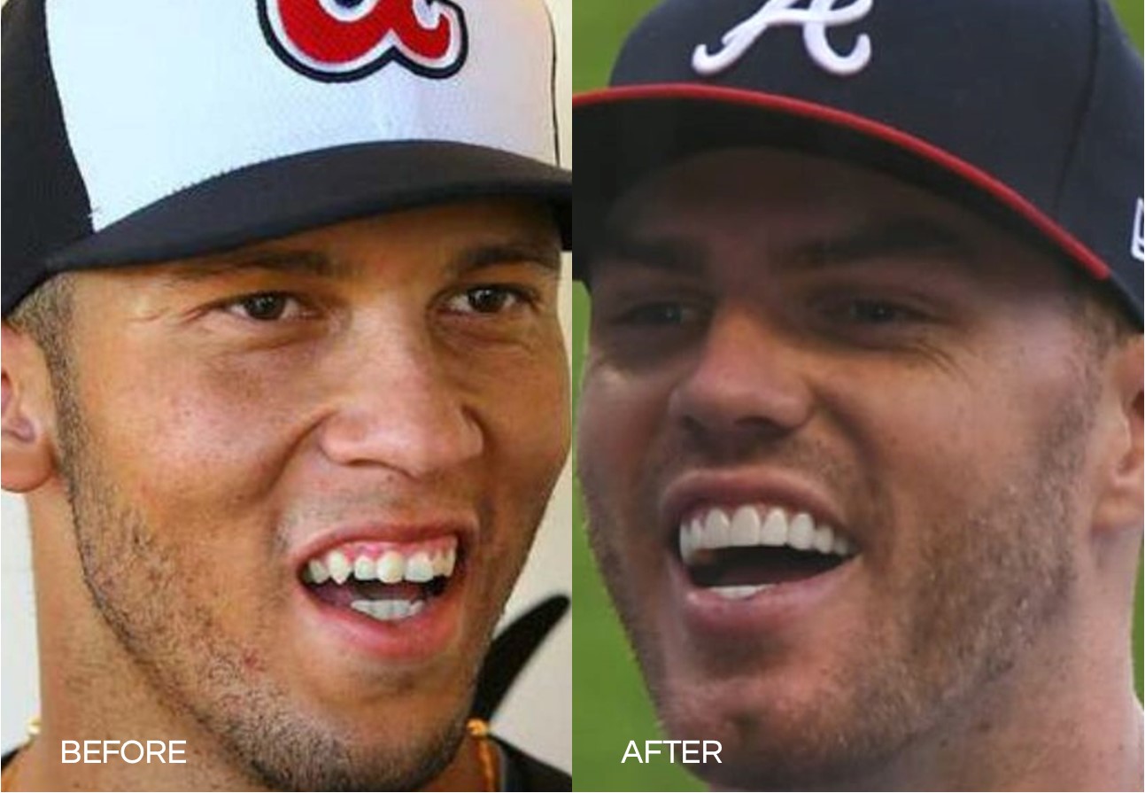 Freddie Freeman Teeth: Science Behind an Iconic Smile