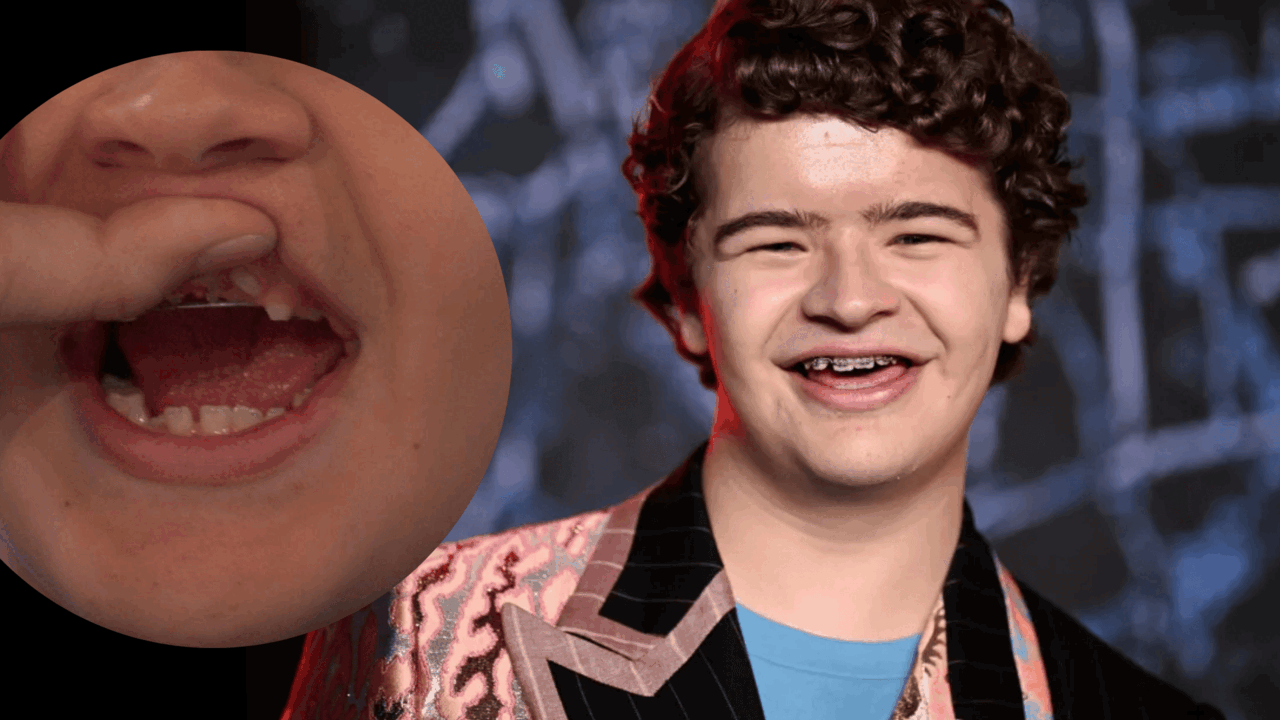 Gaten Matarazzo Teeth Journey: From Genetics to Smile Design