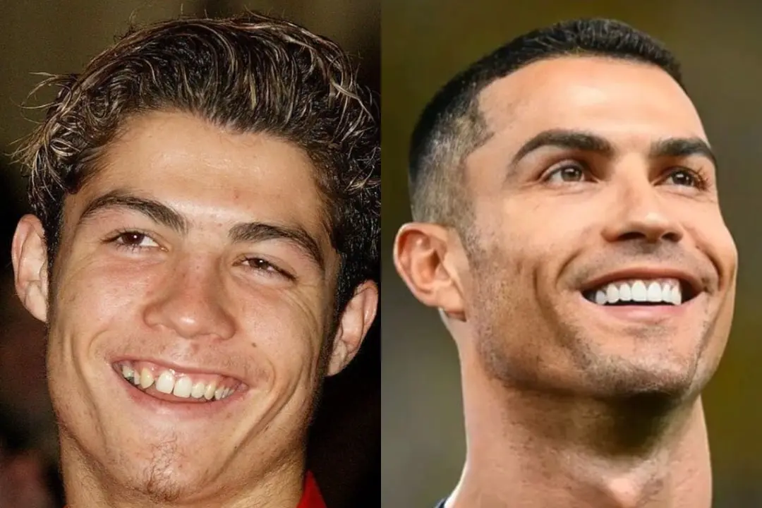 Cristiano Ronaldo Teeth The Science and Art Behind His Iconic Smile