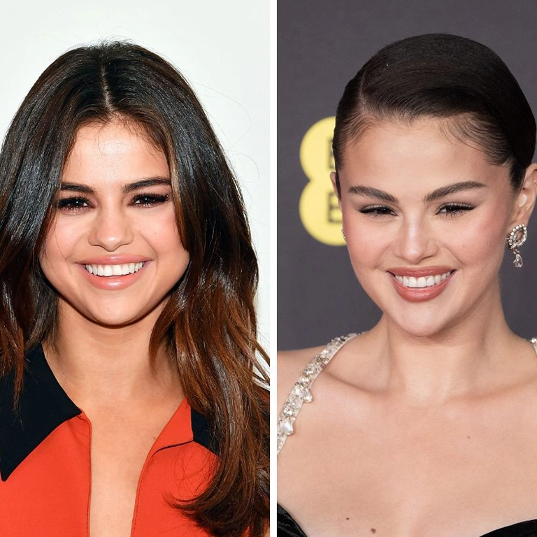 Selena Gomez Teeth Before and After – Evolution of Her Smile