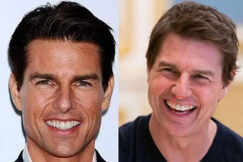 Tom Cruise Teeth: Evolution of the Hollywood Smile