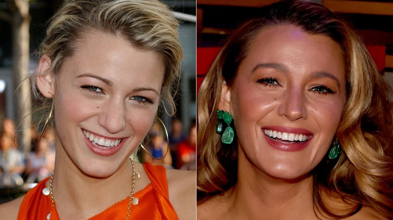 Blake Lively Teeth – Porcelain Veneers Before and After