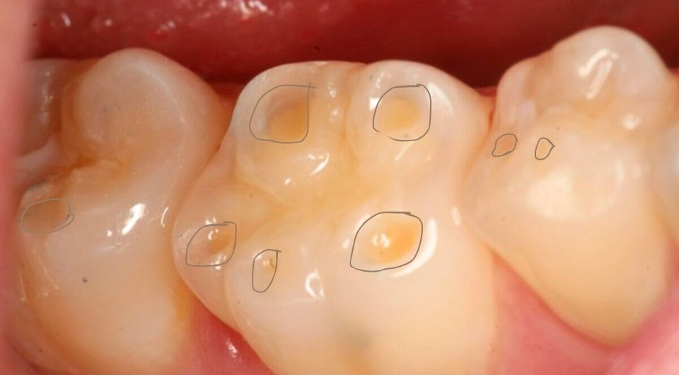 How to Protect Your Teeth from Acid Erosion | DentPrime