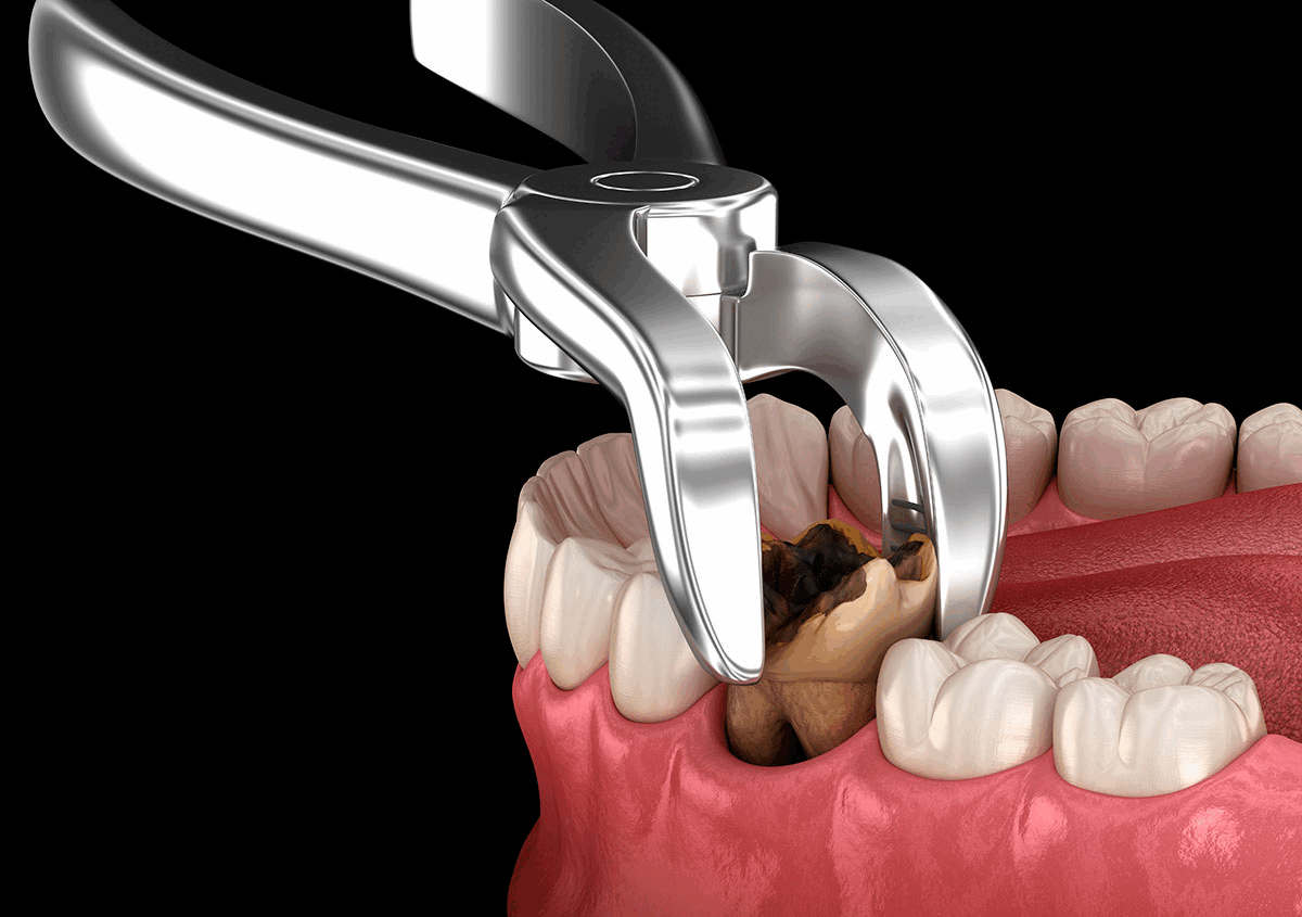 Difficult Tooth Extraction Effects on Jaw and Oral Health