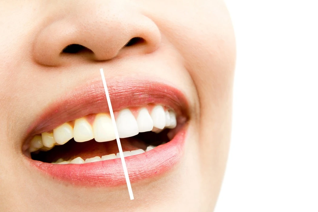 Composite Bonding vs Veneers: Costs, Differences & Lifespan